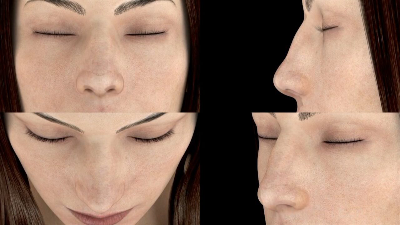 Rinoplastika “Piezo”, modelim i hundës pa thyer kockat – Abc News